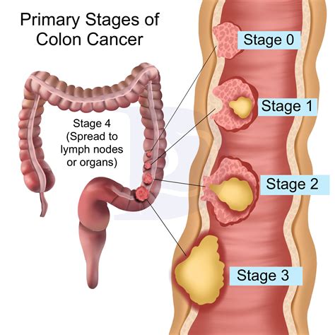Colon Cancer Stool Shape