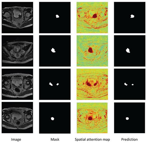 Msedtnet Multi Scale Encoder And Decoder With Transformer For Bladder Tumor Segmentation
