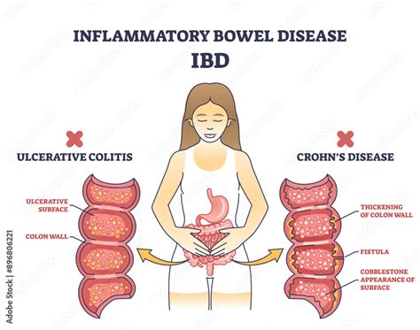 Inflammatory Bowel Disease Or Ibd With Crohns Condition And Ulcerative Colitis Outline Diagram