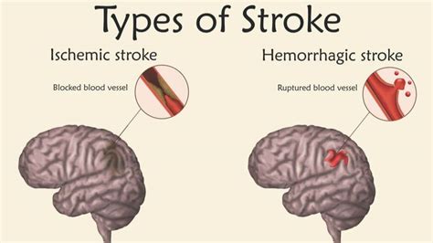 Stroke Types Symptoms And Long Term Outlook 1MD Nutrition