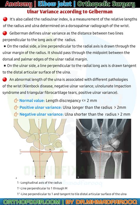 Wrist Joint Ulnar Orthofixar Orthopedic Surgery