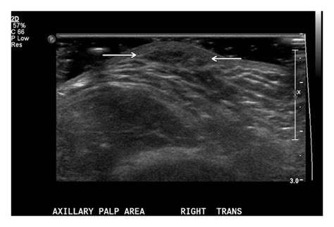 Gynecomastia‐like Hyperplasia Of Axillary Ectopic Breast Tissue In A