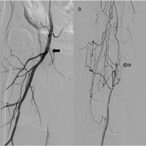 Total Occlusion Of The Left Superficial Femoral Artery Sfa Ryc 1 Download Scientific
