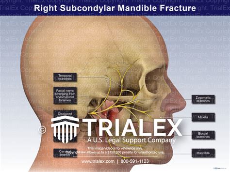 Maxilla Fracture