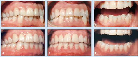Management Of Incisor Crowding Pocket Dentistry