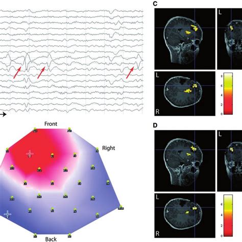 EEG And Correlation Coefficient In A Patient Without Intra MRI Spikes Download Scientific