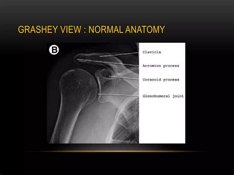 Radiographic Evaluation Of Shoulder Pptx