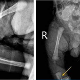 X Ray Radiographic Image Of The Proximal Tibia Download Scientific Diagram