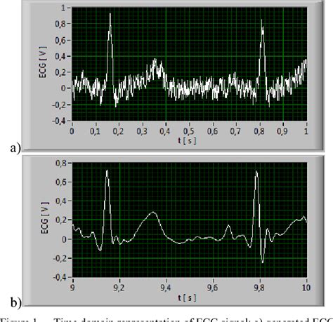Figure 1 From Qrs Time Detection Using Wavelet Multiresolution Analysis For Determining Hrv In