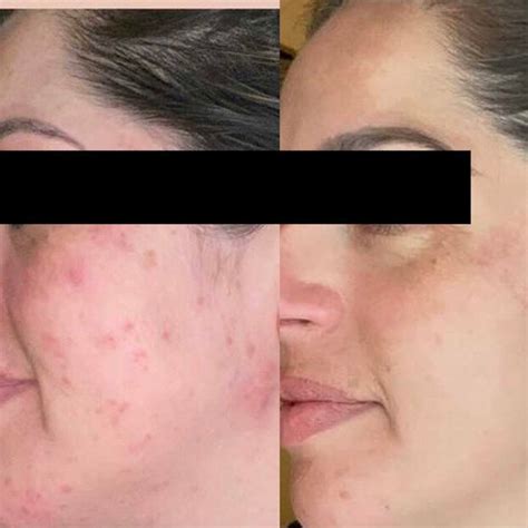 Rosacea Transformation Photos The Rosacea Method Successes