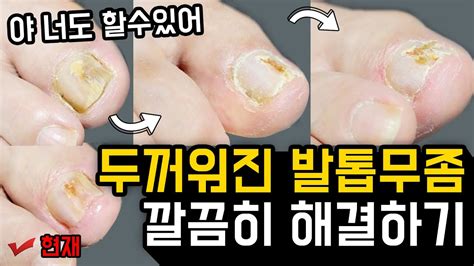 두꺼운발톱 방치하면 어떻게된다 아빠 발톱 스케일링 관리 Youtube