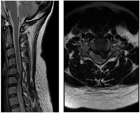 Clinical And Radiological Outcome Of Disc Arthroplasty For The