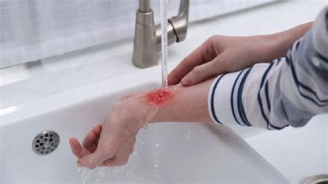 How To Heal Firecracker Burns Safely Healthshots