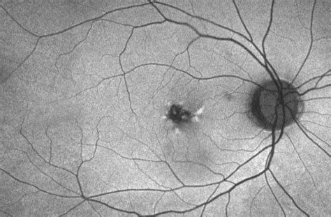 Retinal Pattern Dystrophy Md Searchlight
