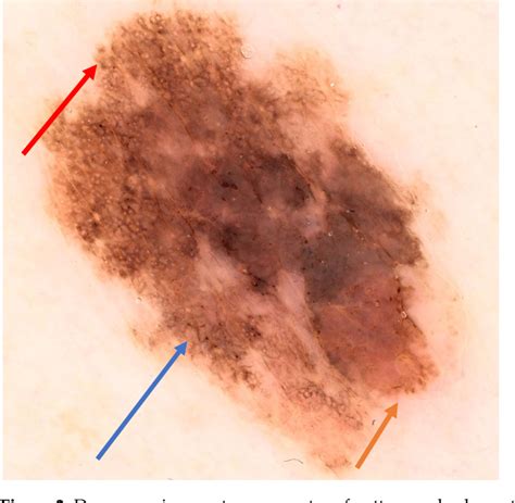 Figure 1 From The Importance Of In Vivo Reflectance Confocal Microscopy In A Case Of