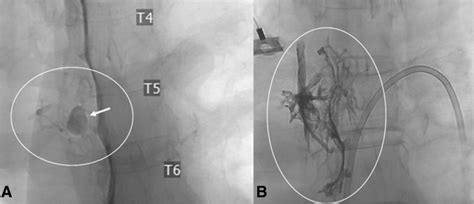 Dsm Image Demonstrating A Right T5 6 Csf Venous Fistula A White Download Scientific Diagram