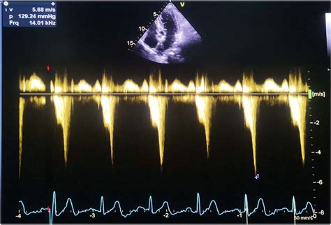 Dynamic Lvoto Detected By Cw Doppler During Dse Download Scientific Diagram