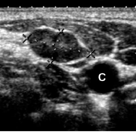 Thyroid Ultrasound In Transverse View Showed A Heterogeneous Parenchyma