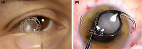 2 Ophthalmologic Applications Of Biomaterials A Artificial Cornea Hip