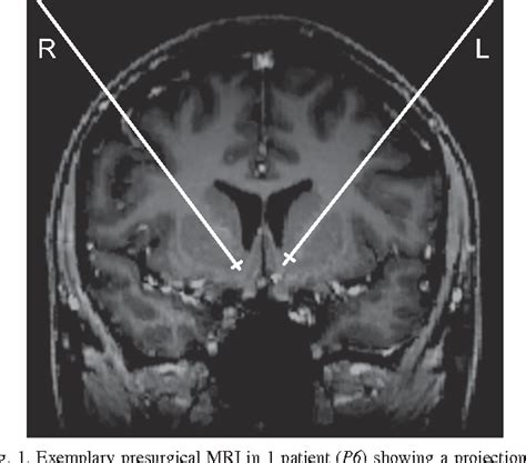 Figure 1 From Perimovement Decrease Of Alpha Beta Oscillations In The Human Nucleus Accumbens