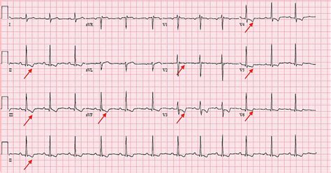 Initial ECG Showing T Wave Inversions In The Inferior And Anterolateral Download Scientific