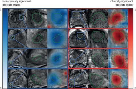 Partin Tables Prostate Cancer Calculator Cabinets Matttroy