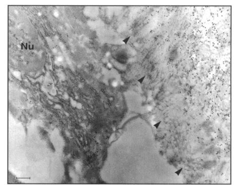 Immunoelectron Microscopy Of An Osteoblastic Osteosarcoma Using