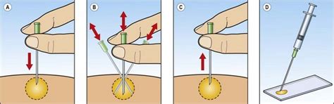 The Techniques Of Fna Cytology Basicmedical Key