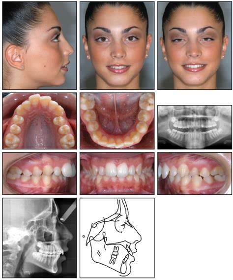 Class Ii Elastics And Skeletal Anchorage
