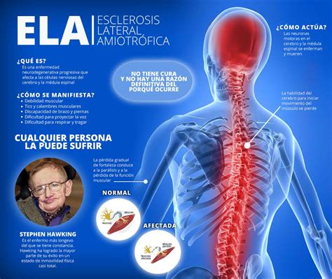 Esclerosis Lateral Amiotrófica Fisiopatología Pfplcp