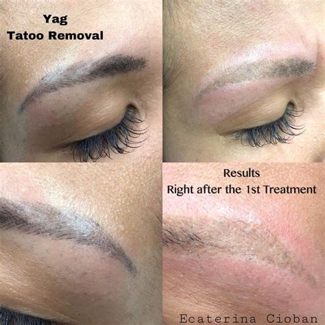 Laser Pmu Microblading And Eyebrow Tattoo Removal Montreal