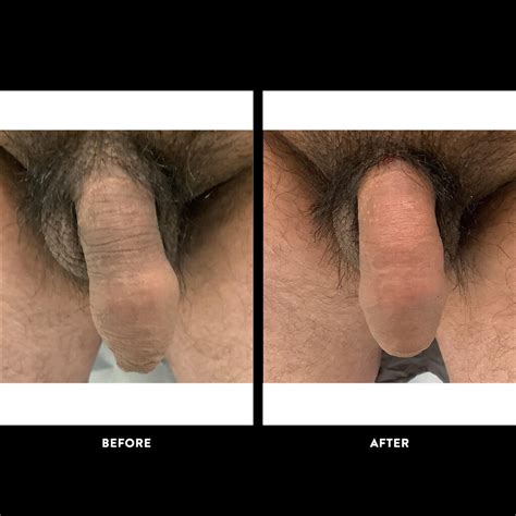 Non Invasive Penis Enlargement Rowe Plastic Surgery™