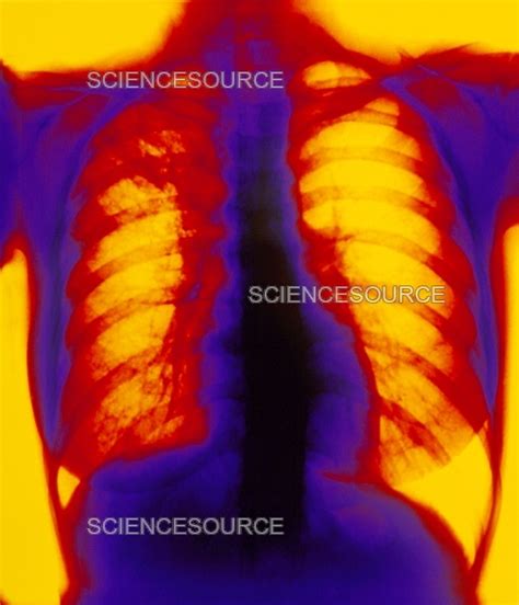 X Ray Showing Pulmonary Tuberculosis Stock Image Science Source Images