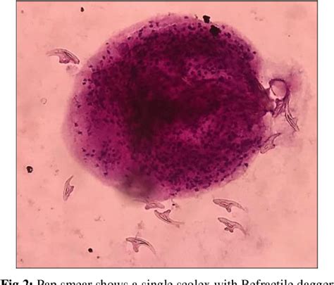 Figure 2 From Hydatid Cyst Of Parotid Gland Mimicking As Branchial Cyst