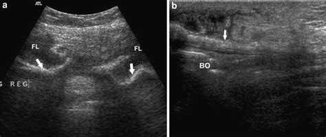 Hernias Volvulus And Intussusception Abdominal Key