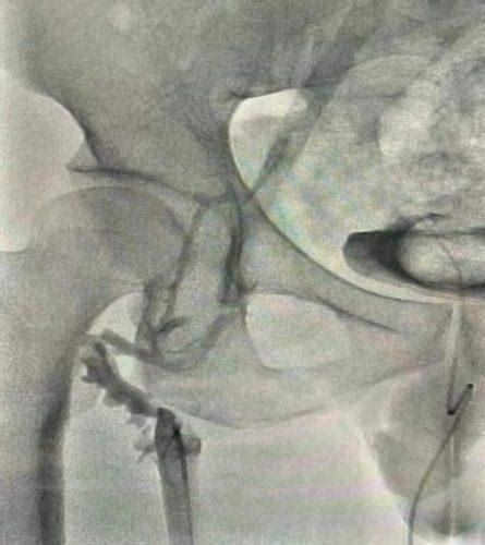 世界首位应用我国自主研发的血栓抽吸系统的患者顺利康复出院 知乎