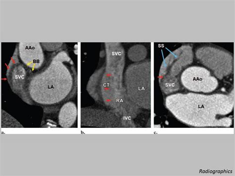 The Pump And The Tubes Crista Terminalis