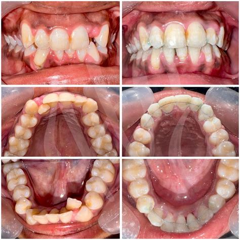 Dr Hari Govind G On Linkedin Class 2 Div2 The Classical Features Of Angles Class Ii Div 2 Dr Hari Govind G On Linkedin Class 2 Div2 The Classical Features Of Angles Class Ii Div 2