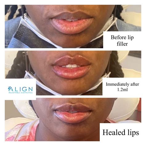 Lip Filler Healing Process Lip Fillers Healing Process Lips