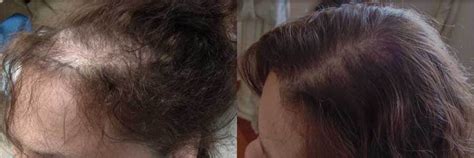 Female Fue Hair Transplant Hairline Envy