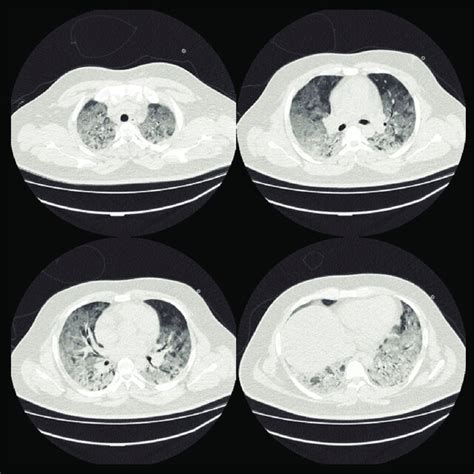 Pulmonary Tomography Showing Diffuse Alveolar Interstitial Infiltrate Download Scientific
