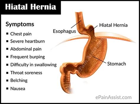 Diet For Hiatal Hernia Foods To Include And Foods To Avoid