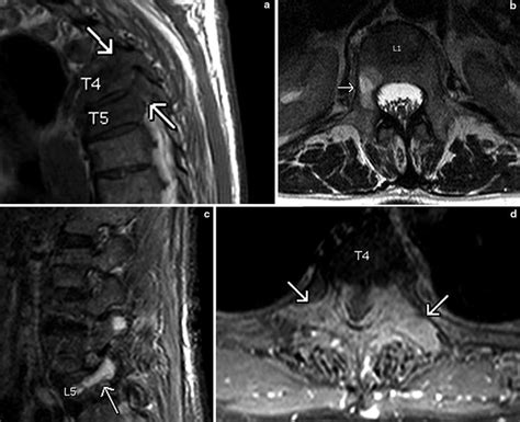 And Malignant Vertebral Fractures Radiology Key