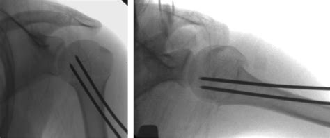 Percutaneous Pinning