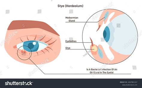 Eyelids Conjunctivitis Over 213 Royalty Free Licensable Stock Vectors