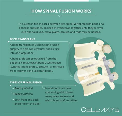 How To Recover After Spinal Fusion Surgery At Timothy Samons Blog