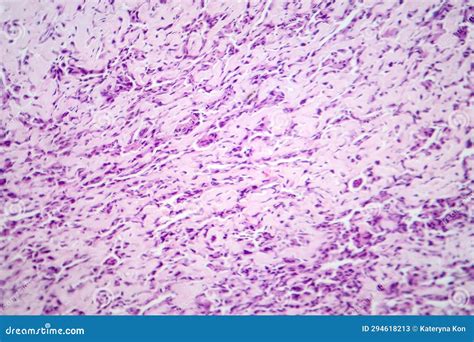 Osteosarcoma A Malignant Bone Tumor Light Micrograph Under The Microscope Royalty Free Stock