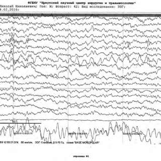 EEG Pattern In The Examined Patient From The Group Of Clinical Comparison Download Scientific