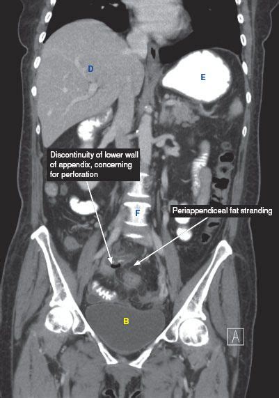 Appendix Radiology Key