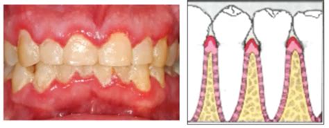 Classification Of Perio Dz 1 Flashcards Quizlet